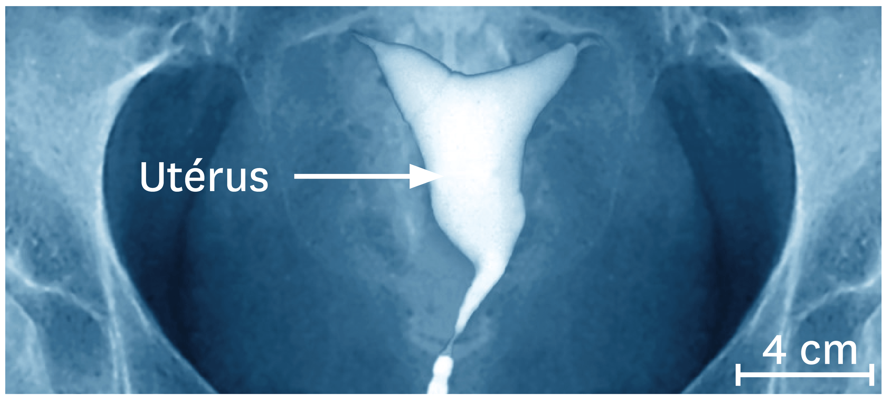 Une radiographie de l’utérus de Mme B.