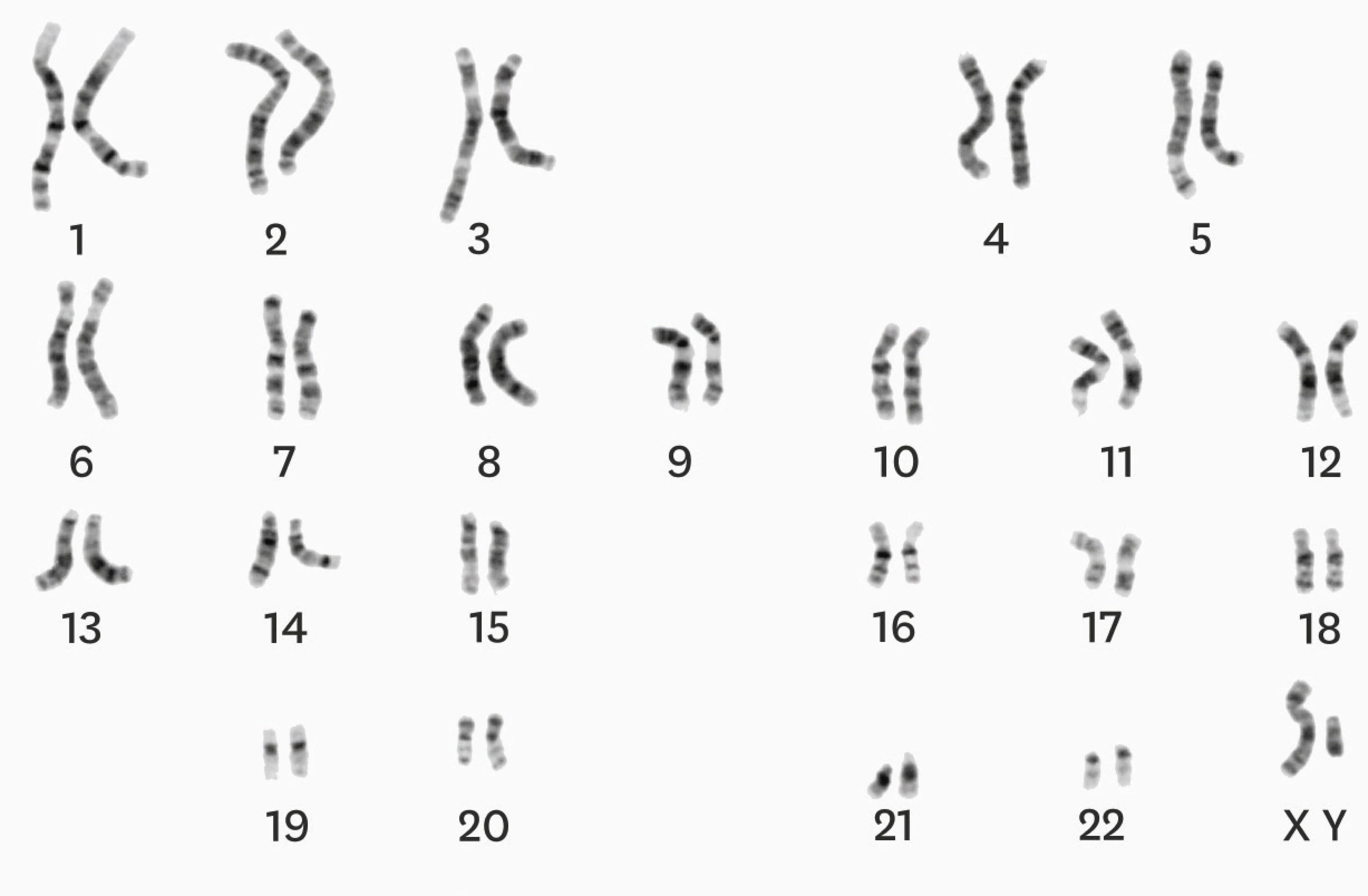 Le caryotype d'une cellule œuf issue de la fécondation.